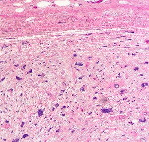 Lipoma - Symptoms, Pictures, Causes, Removal, Surgery, Treatment