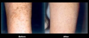 Hemosiderin | e Medical Hub